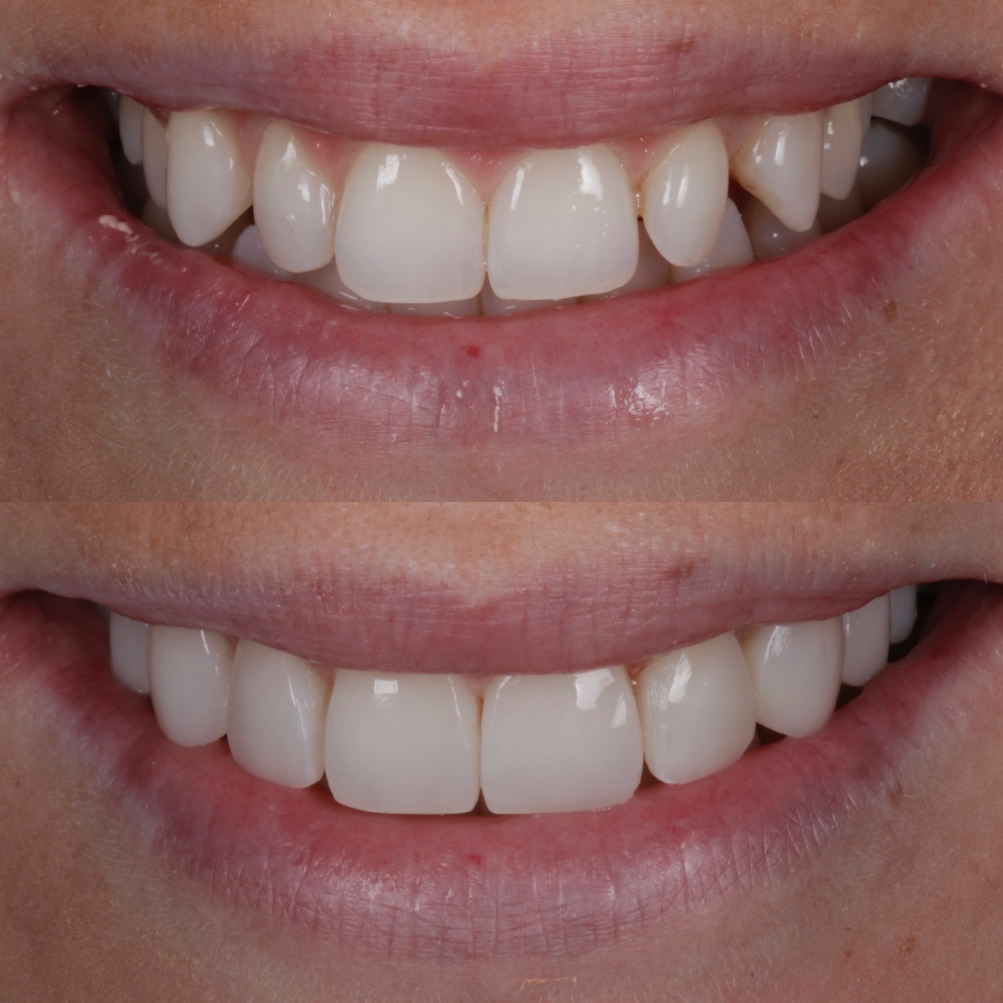 Composite Bonding Near Me: Edinburgh EH1 3QN