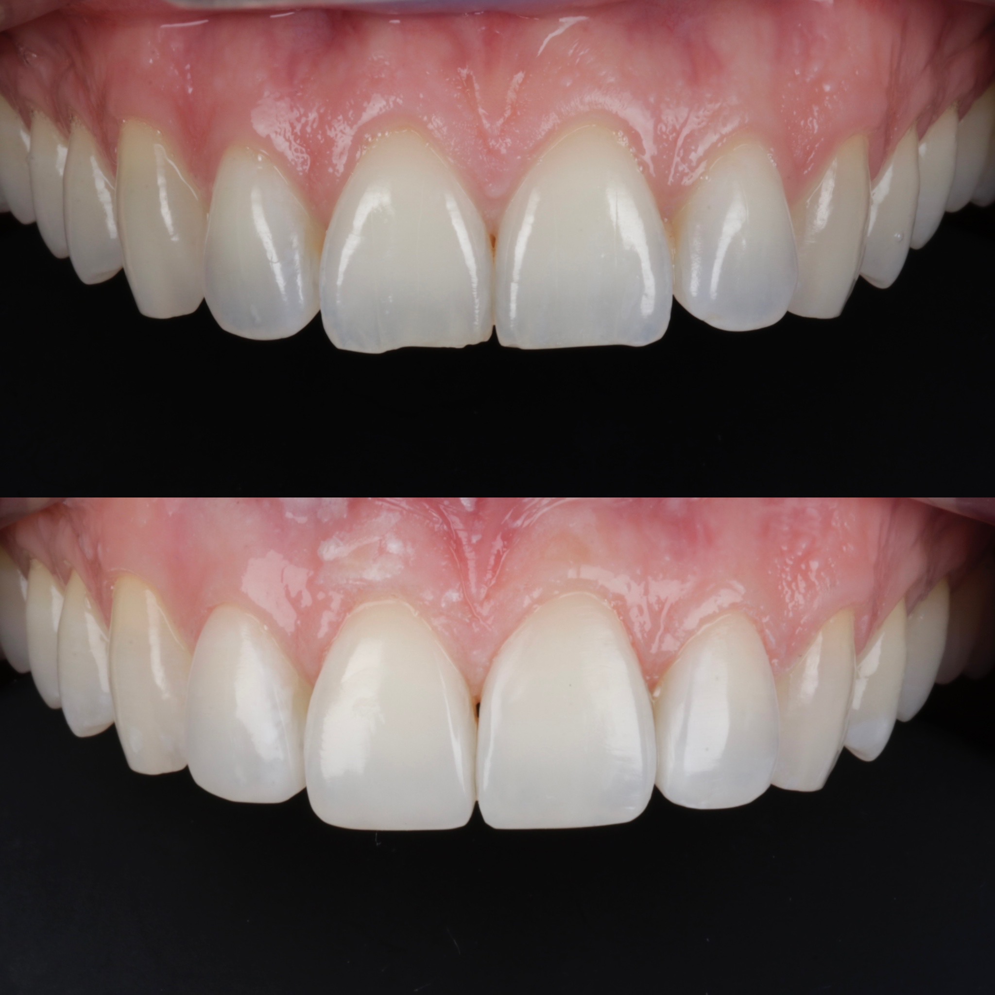 Composite Bonding Near Me: Edinburgh EH1 3QN